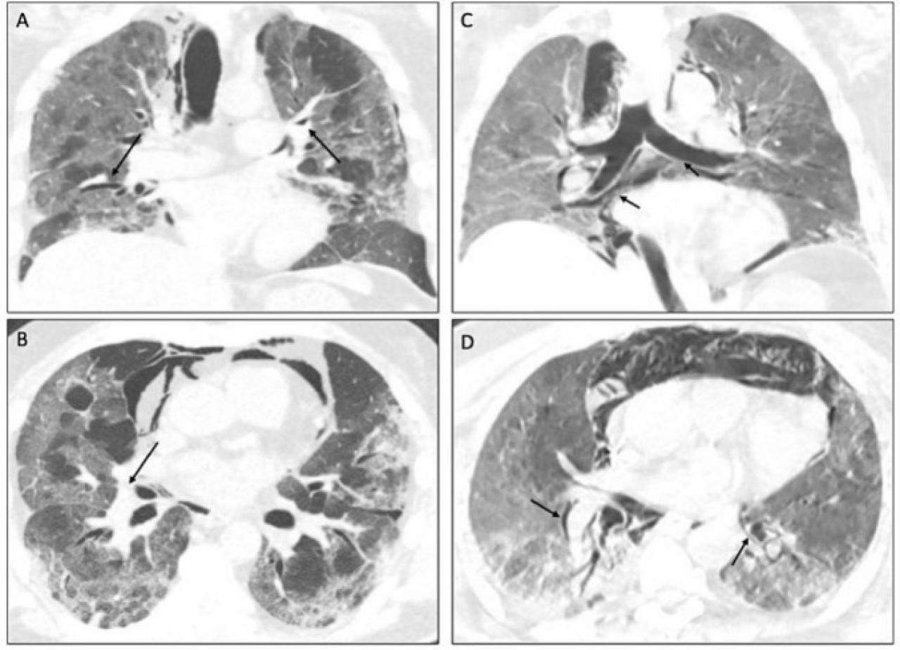 Radiographic Sign May Identify Patients at Risk for Pulmonary ...