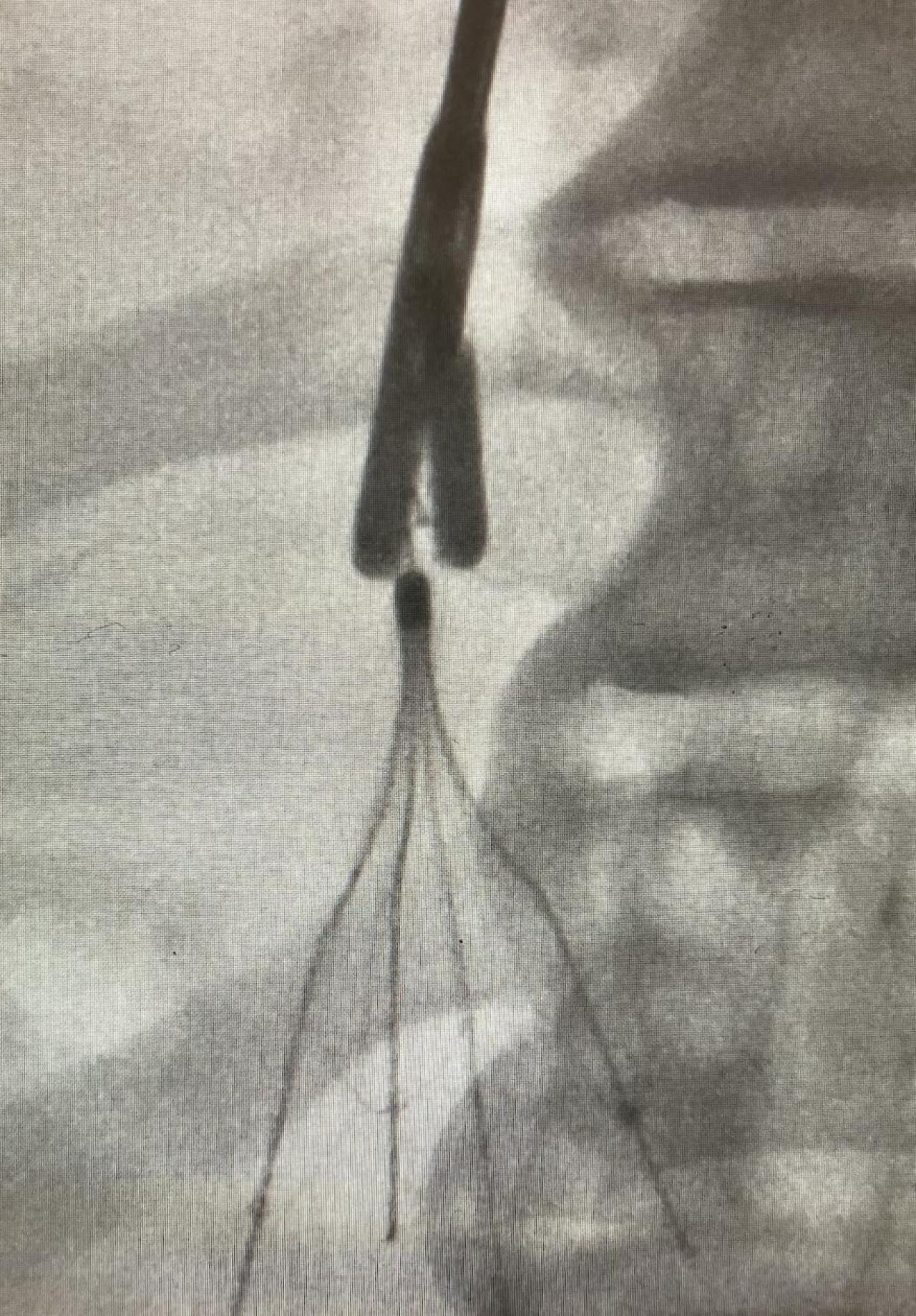 Not all IVC Filters Are Permanent: Advanced Techniques Retrieve Hard-to ...