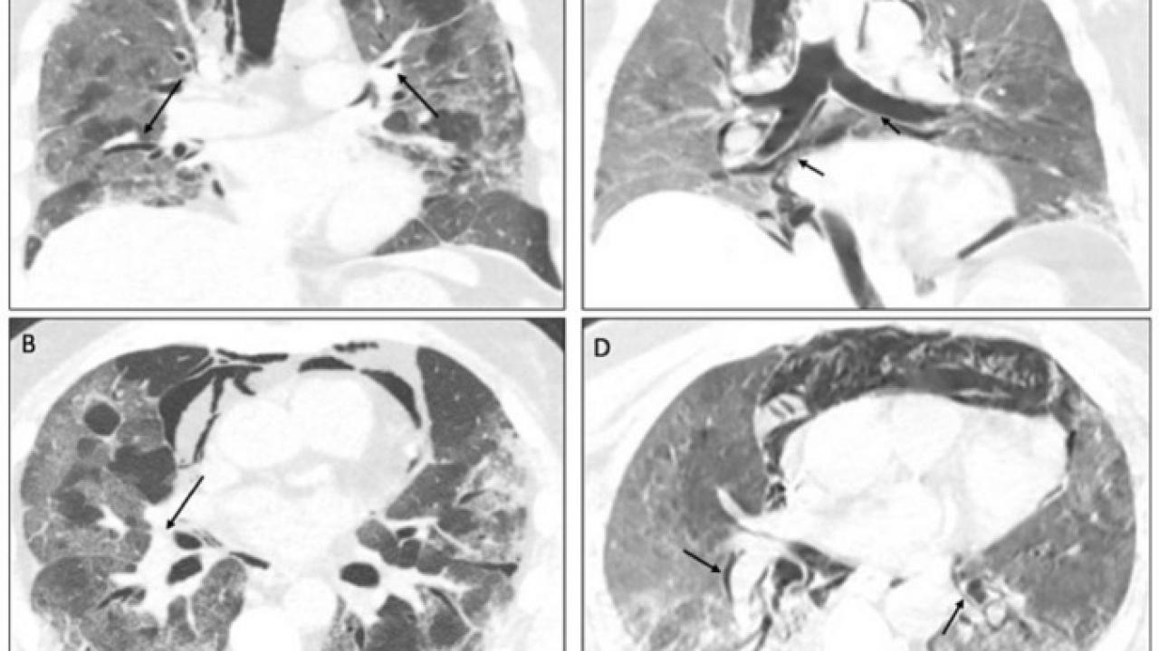 Radiographic Sign May Identify Patients at Risk for Pulmonary ...