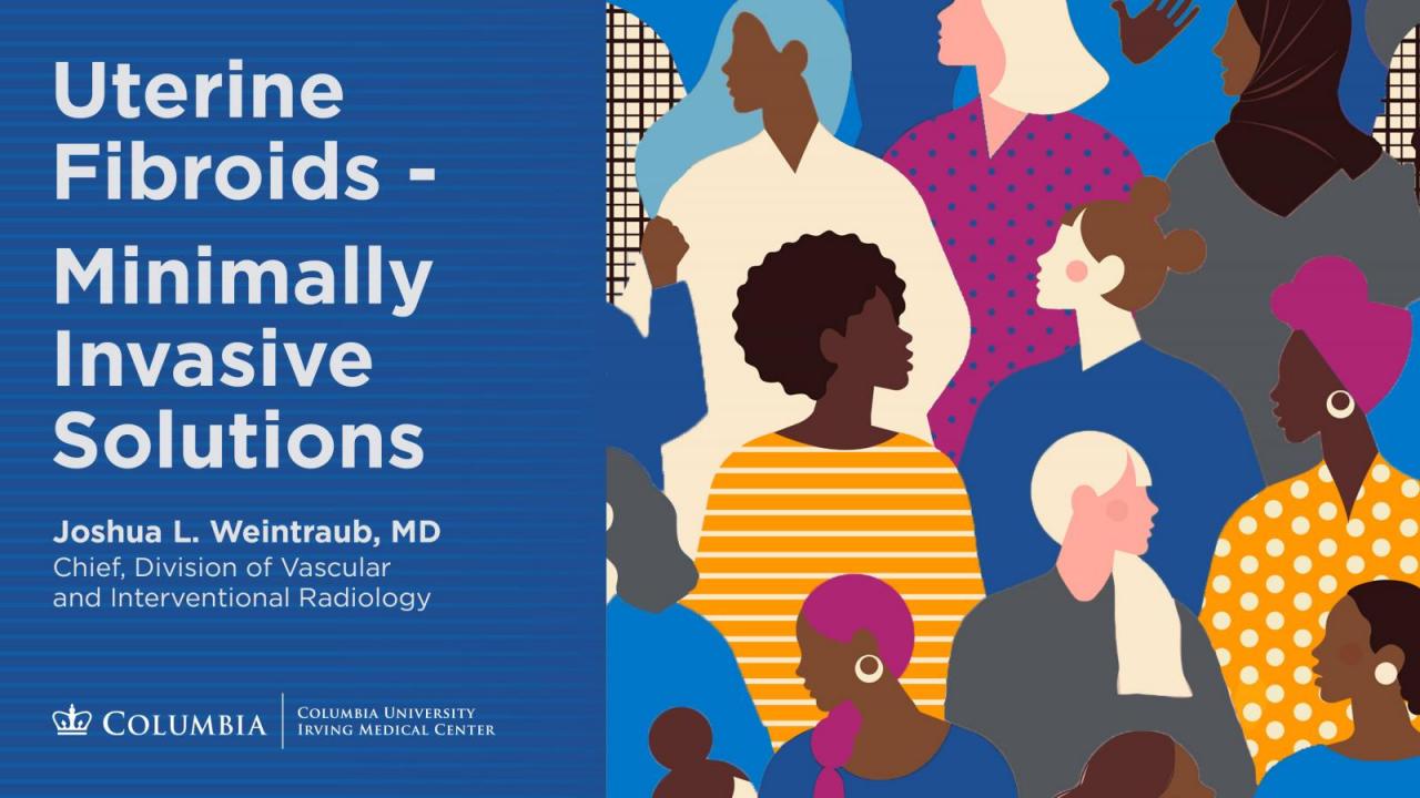 Uterine Fibroids - Minimally Invasive Solutions | Columbia Department ...