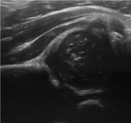 Hip Dysplasia Ultrasound Introduced at ColumbiaDoctors Tarrytown ...