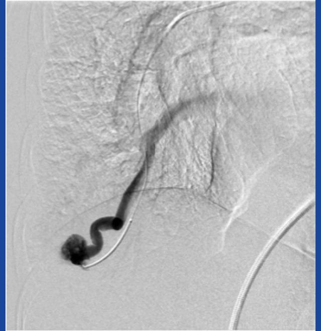 Columbia Designated Hereditary Hemorrhagic Telangiectasia (HHT) Center ...