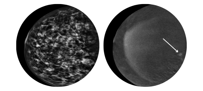 What is Contrast Enhanced Mammography? | Columbia Department of Radiology