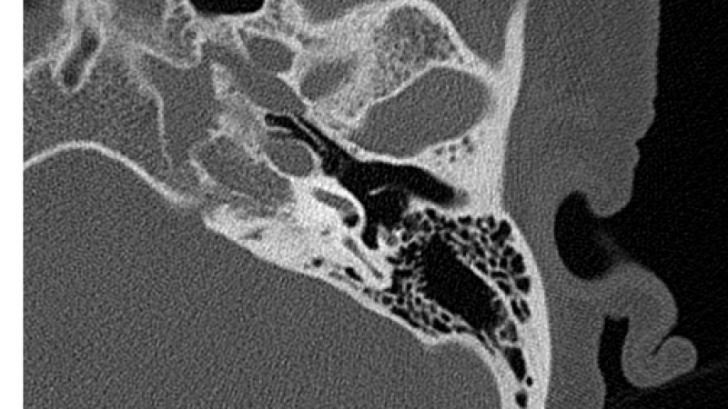 Neuroradiology | Columbia Department of Radiology